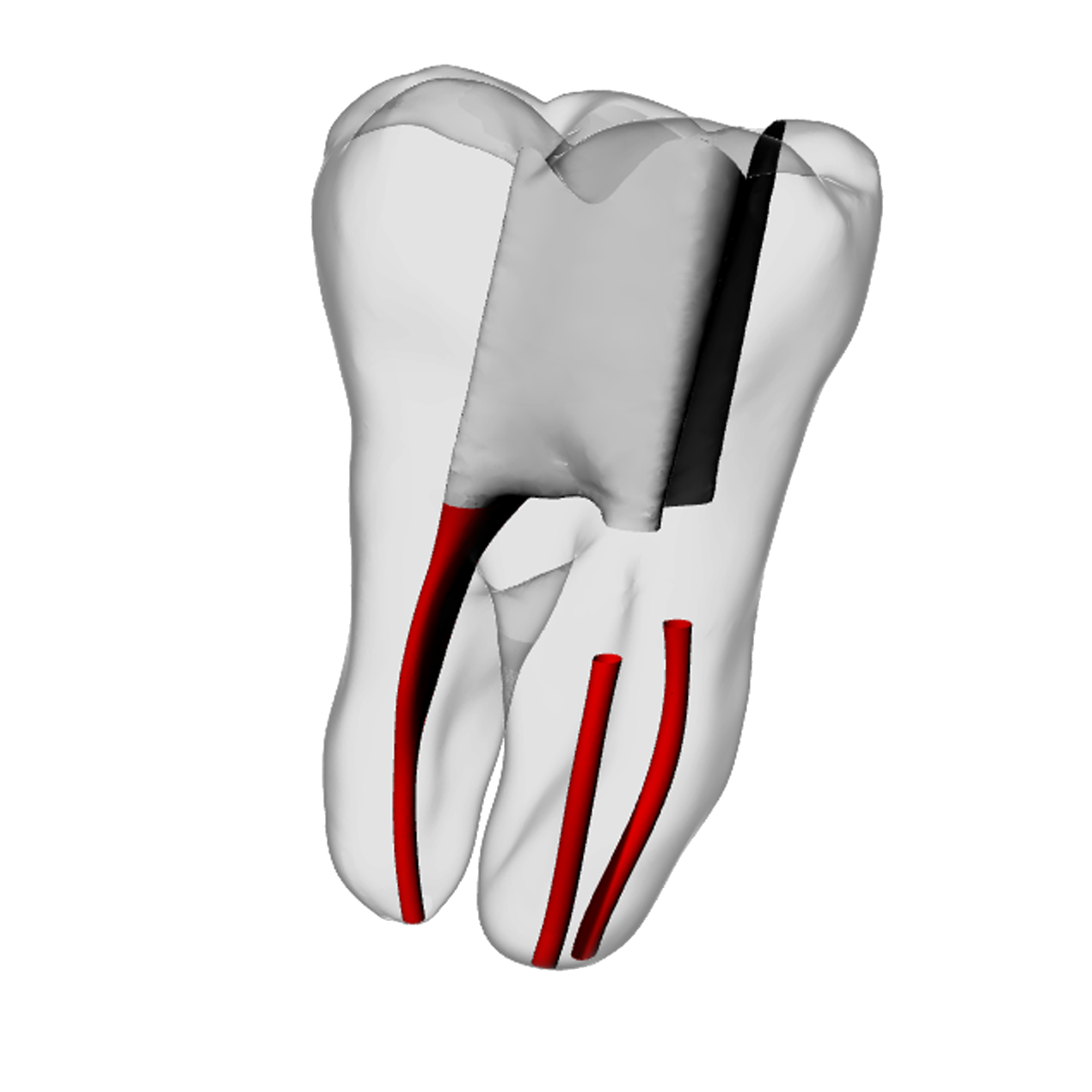 Molar – Obliterated | Dental Training Models | DRSK