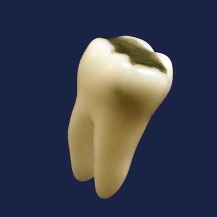 Tooth Restoration Model | Dental Training Models | DRSK