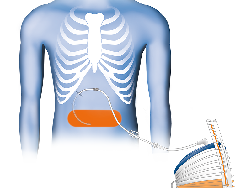 Aszites oder Wasser im Bauch? Hier informieren | ewimed