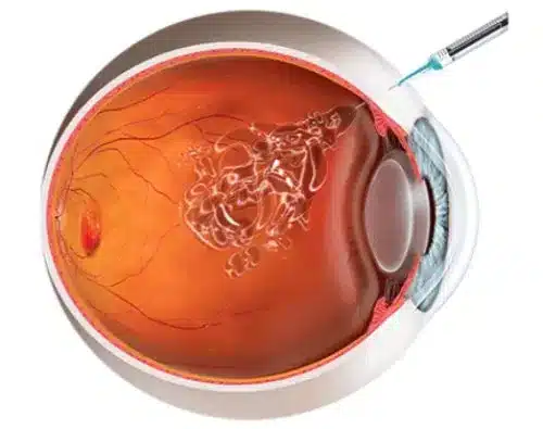 Intravitreal Injection | Eye of Cairo, Dr Khalil Eye Clinic