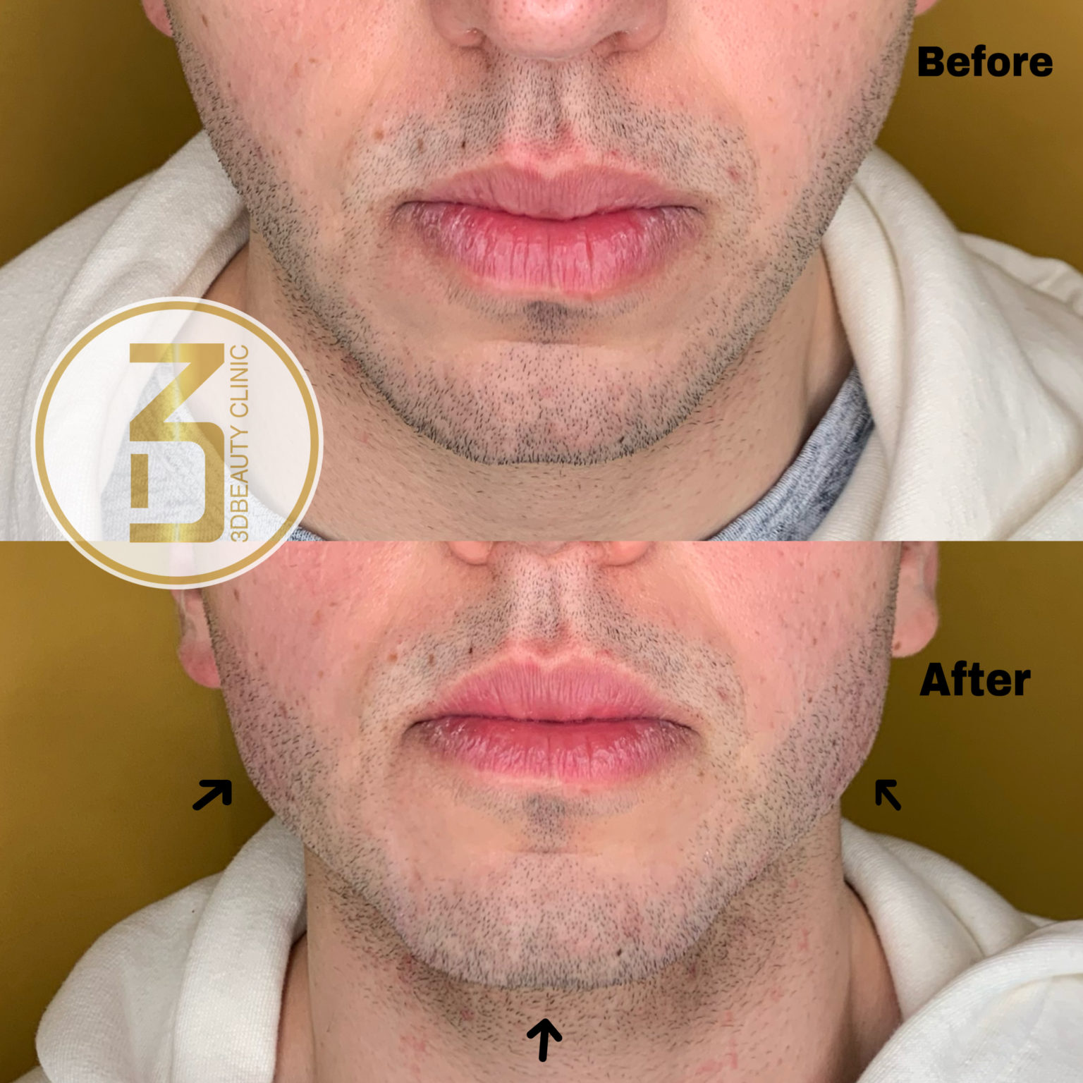 Fillers haka - Balancera ansiktsprofilen & V-format ansikte - 3dbeauty ...