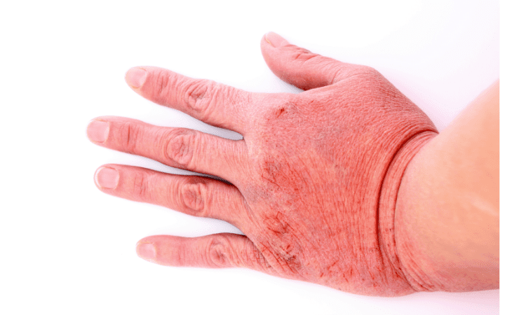 How Laundry Detergent Can Cause Contact Dermatitis » AajKaAkhbaar.com ...