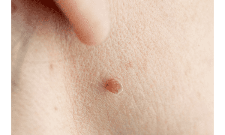 Understanding Skin Tags: How to Remove Them Safely and Effectively ...
