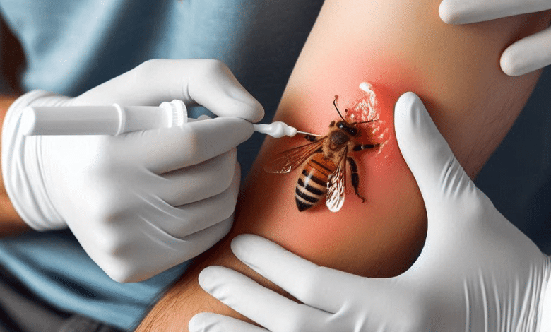 Best Practices For Bee Sting Treatment In Children