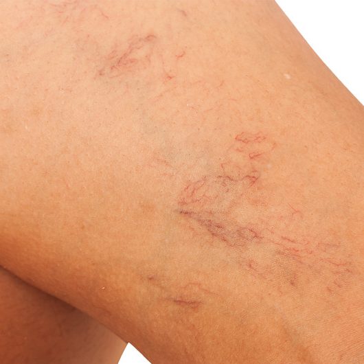 Mooie benen voor de zomer : weg met spataders! - Cosmedics