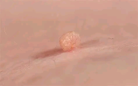 Understanding Skin Tags: Why They Develop and How to Remove Them ...