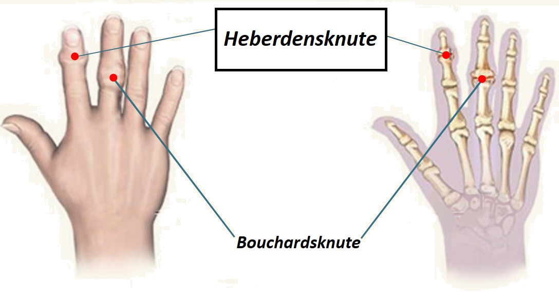 En Guide om Heberdensknuter - Din Helsebutikk