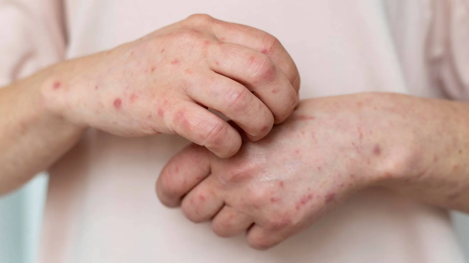 Allergisk reaksjon – symptomer og behandling (2023)