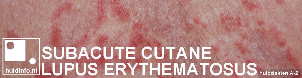 Subacute cutane lupus erythematosus | huidinfo.nl - dermatoloog