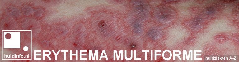 Erythema multiforme | huidinfo.nl - dermatoloog
