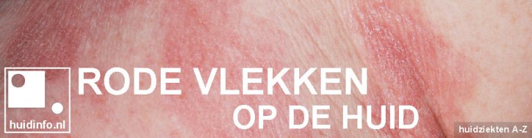 RODE VLEKKEN OP DE HUID - oorzaken met FOTO's | info van de dermatoloog
