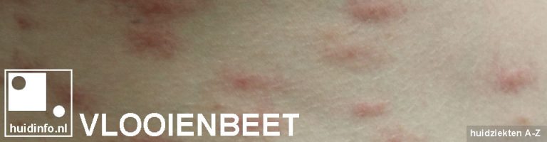 VLOOIENBETEN | uitleg van de dermatoloog | huidinfo.nl - dermatoloog