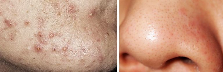 Mee-eters | info van de dermatoloog