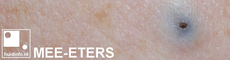 Mee-eters | info van de dermatoloog