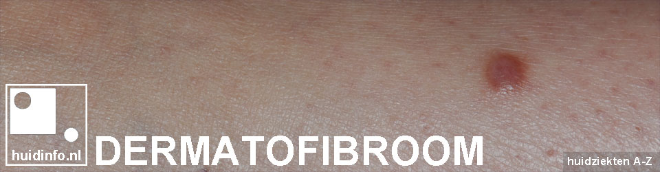 Dermatofibroom | huidinfo.nl - dermatoloog