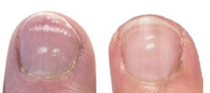 Witte nagels | info van de dermatoloog