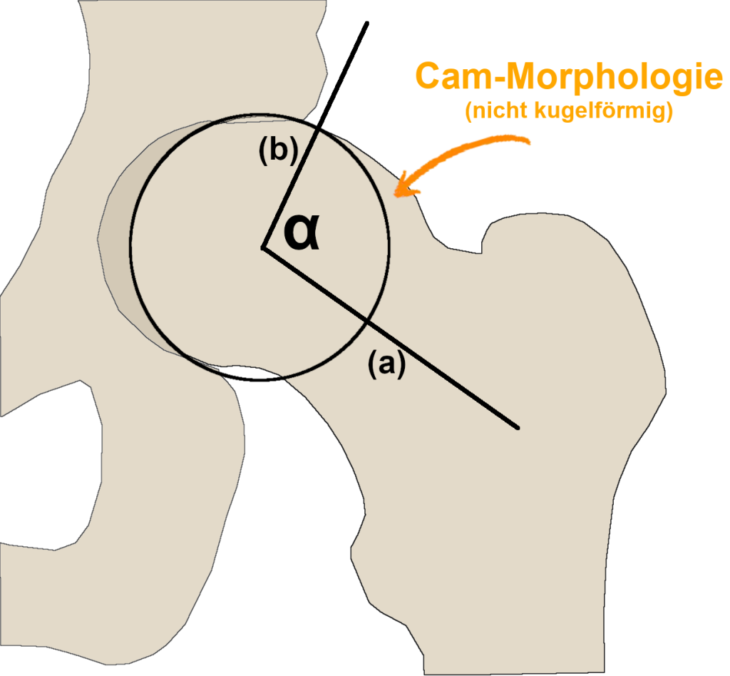 Was ist ein primäres Cam-Impingement? | Impingement Hüfte