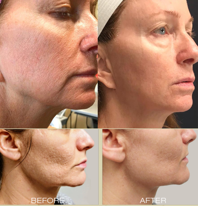 Radiofrequency RF Combined Microneedling Skin Tightening Treatment Ink ...
