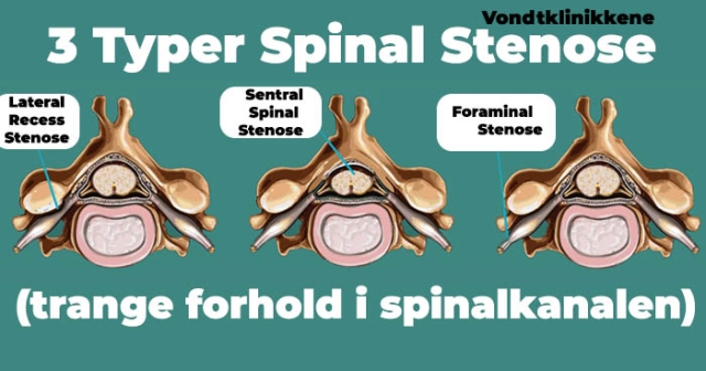 Lateral Recess Stenose i Ryggen | Lambertseter Kiropraktorsenter