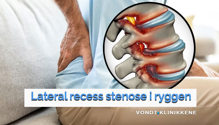 Lateral Recess Stenose i Ryggen | Lambertseter Kiropraktorsenter