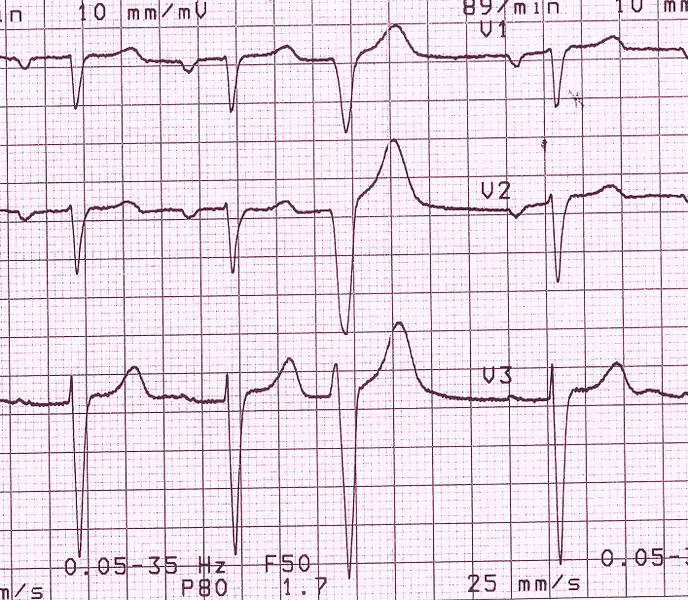 Extrasistoli: cosa sono, cause, quando preoccuparsi - Natural Magazine