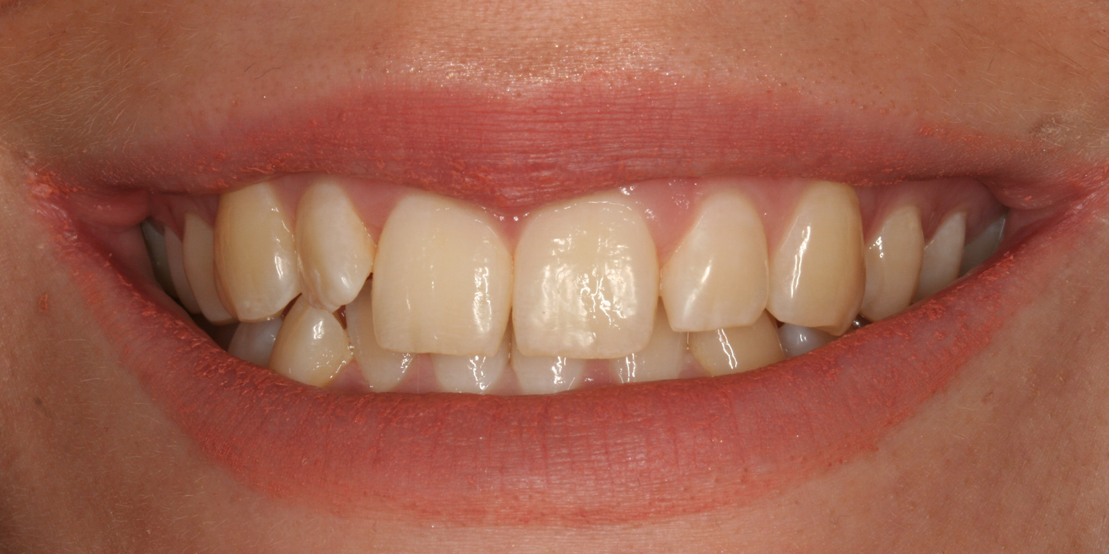 Smile Makeovers Falmouth | Cosmetic Dentist Carnon Downs