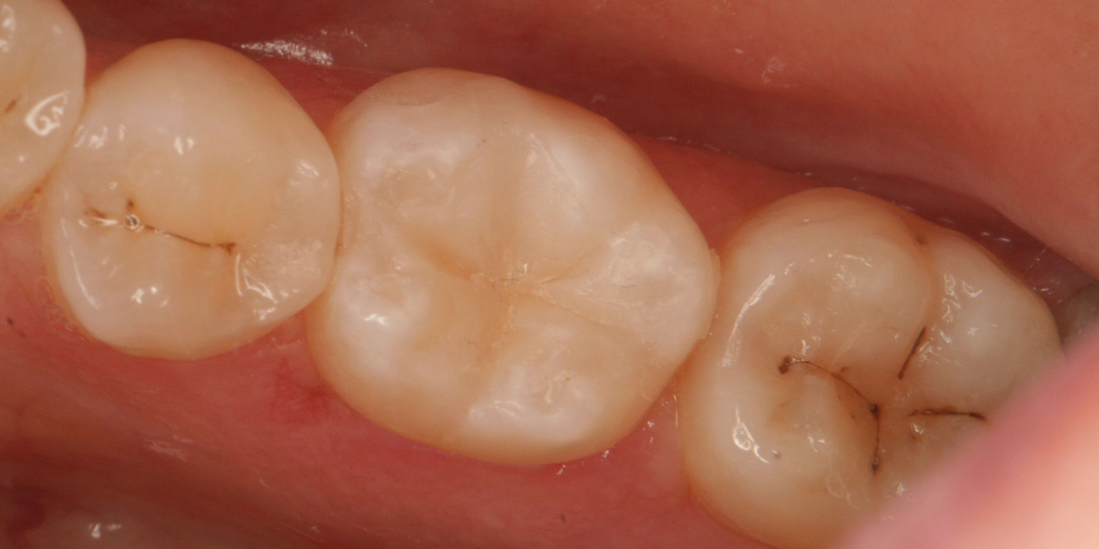 White Composite Fillings Falmouth | Observatory Dental Practice