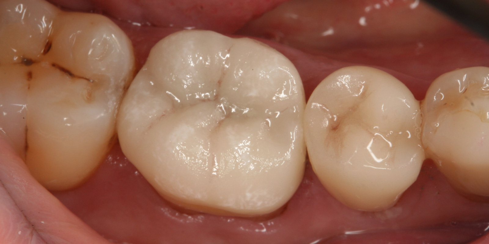 Dental Onlay Tooth Repair Falmouth | Observatory Dental Practice