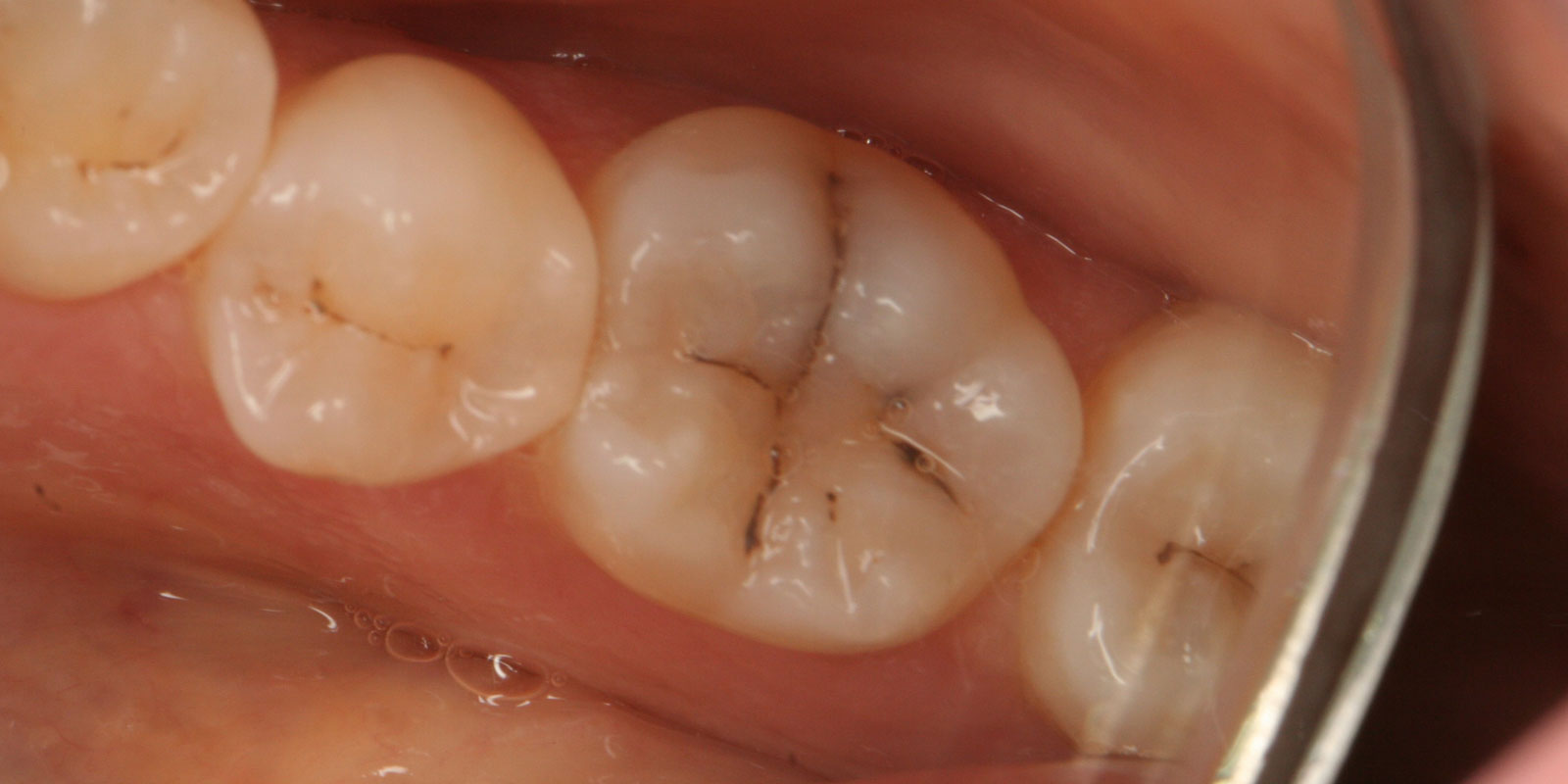 White Composite Fillings Falmouth | Observatory Dental Practice