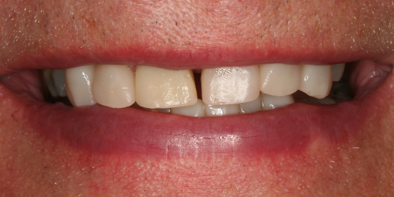 We restore Worn Teeth | Tooth Wear | Damaged Teeth in Falmouth