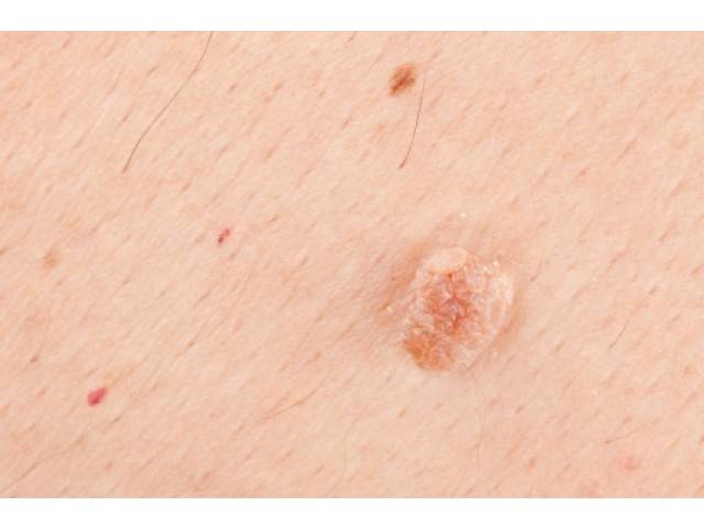 FRYSEBEHANDLING AV VORTER – Ovid medisinske klinikk