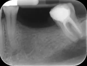 Endodontics Re-Treatment | Root Canal | Dentist Victoria