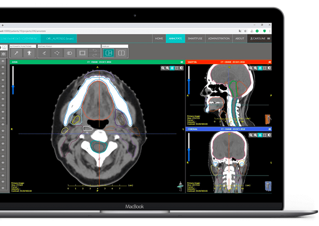 Adaptive radiotherapy solution, cancer care AI, contouring software
