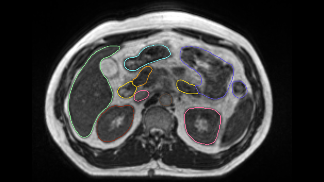 MR-guided radiotherapy: a new hope for pancreatic cancer? - TheraPanacea