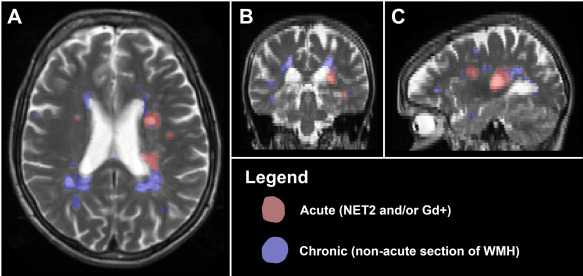 Multiple Sclerosis: new AI model classification chronic/acute lesions