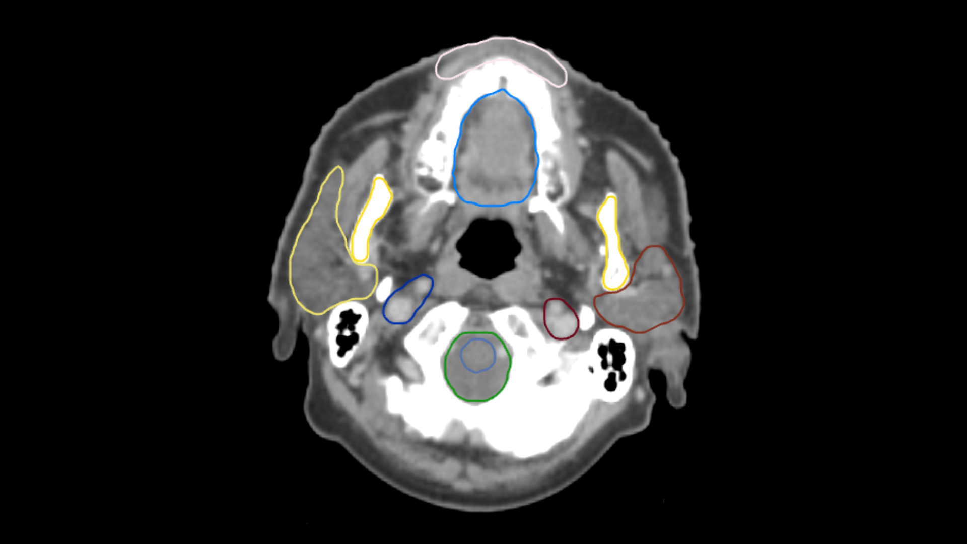 Adaptive radiotherapy solution, cancer care AI, contouring software