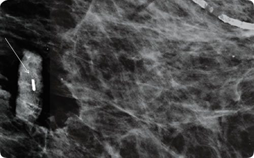 MammoMark & CorMark – Veins Medical